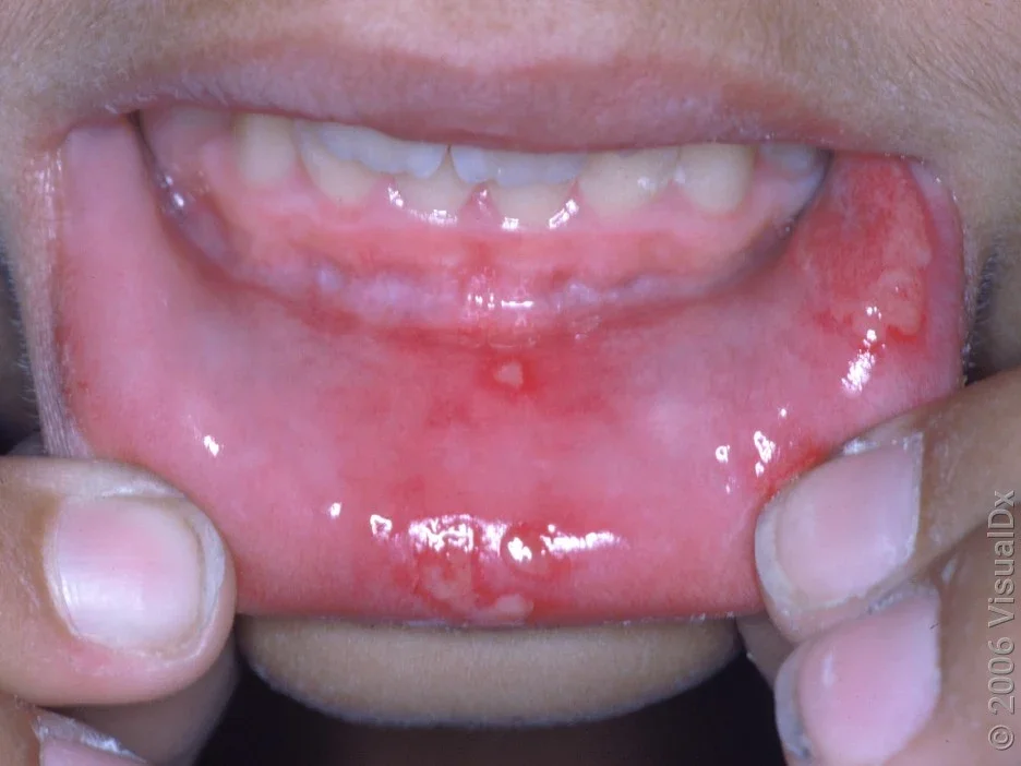 How Long Do Canker Sores Last ? - GoodRx