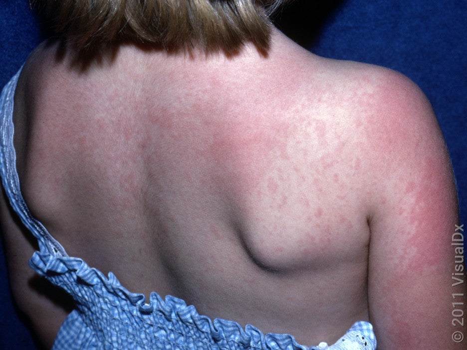 What Is Scarlet Fever? Symptoms, Causes, and Treatments - GoodRx