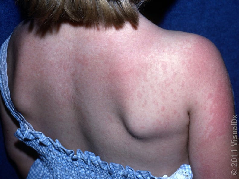 What Is Scarlet Fever? Symptoms, Causes, and Treatments - GoodRx
