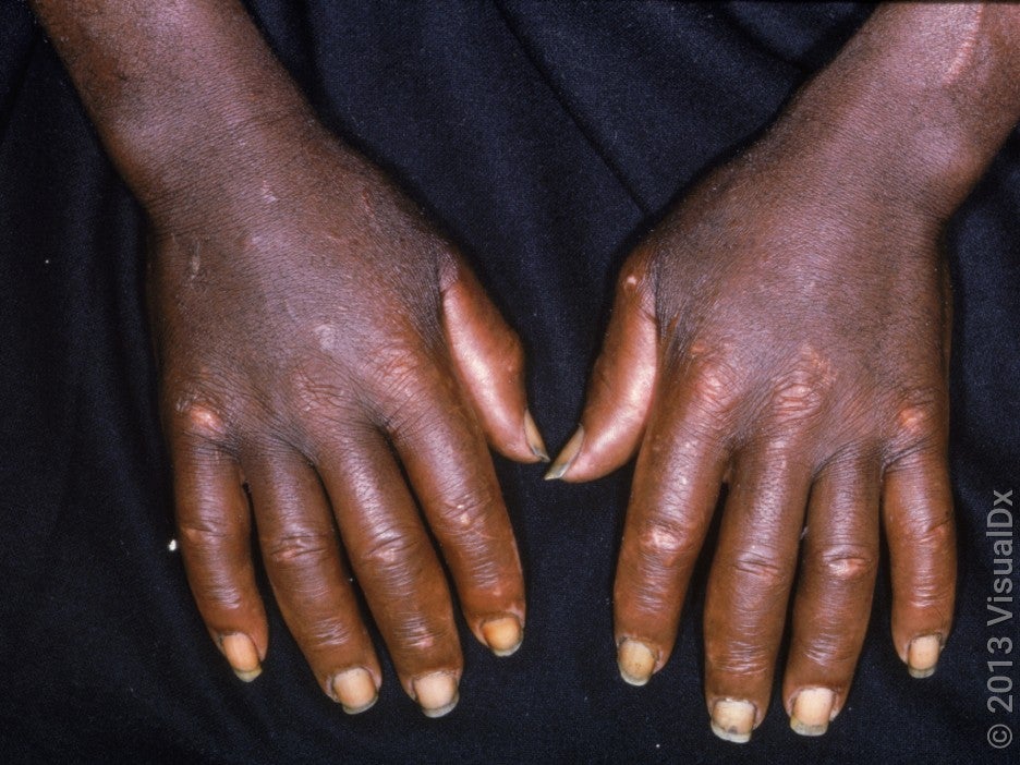 What Is Scleroderma? Causes, Symptoms, and Treatment - GoodRx