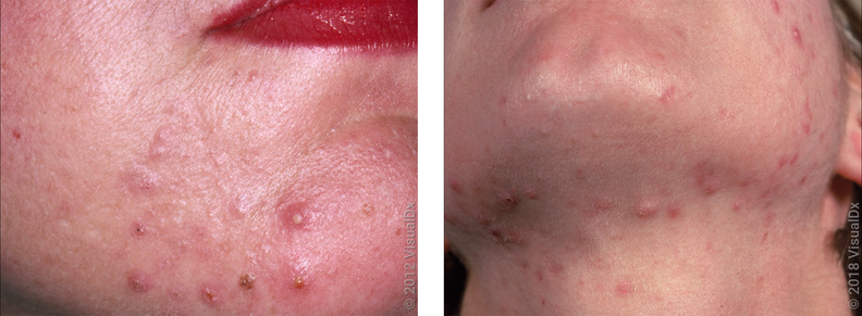 What Does Hormonal Acne Look Like? Images, Signs, and Treatment - GoodRx