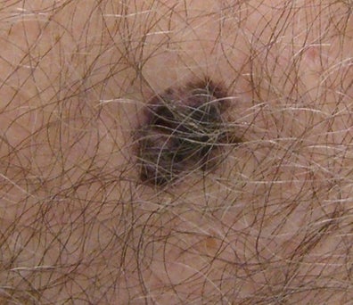 What Does Skin Cancer Look Like? - GoodRx