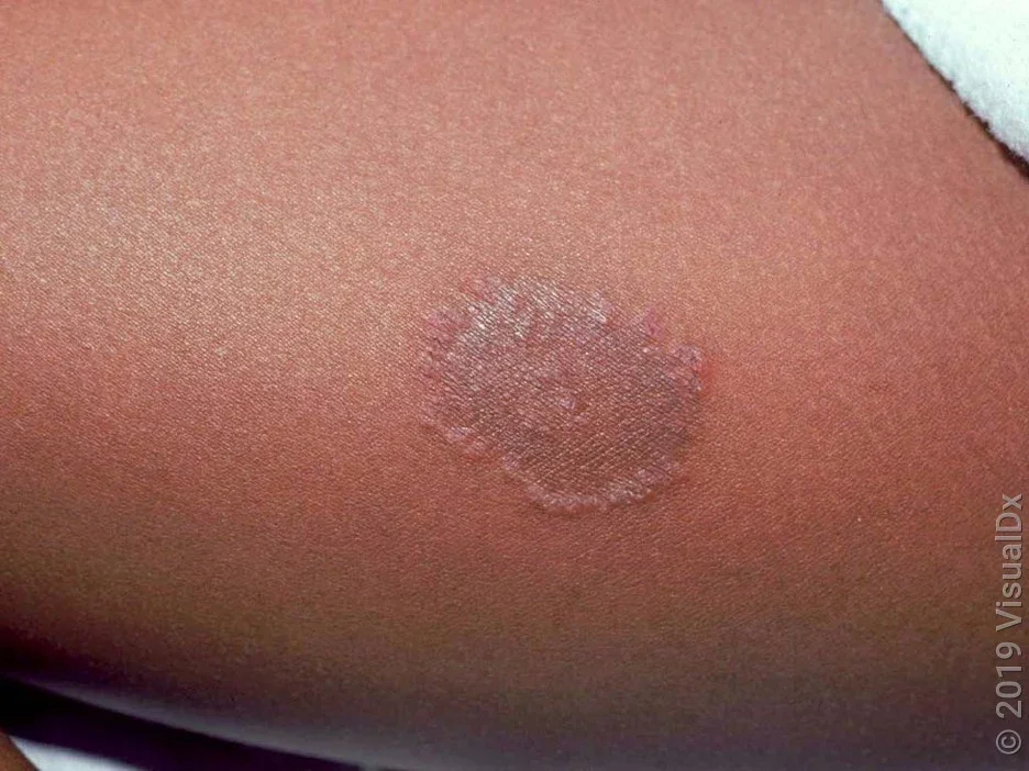 11 Common Rashes on Kids and Preschoolers (With Images) - GoodRx
