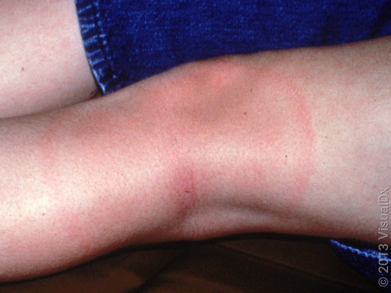 Tick Bite Treatment and Prevention (Image Guide) - GoodRx