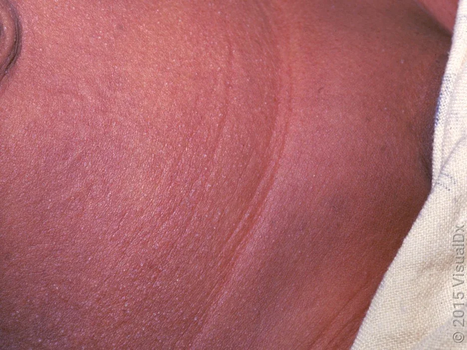 What Is Scarlet Fever? Symptoms, Causes, and Treatments - GoodRx