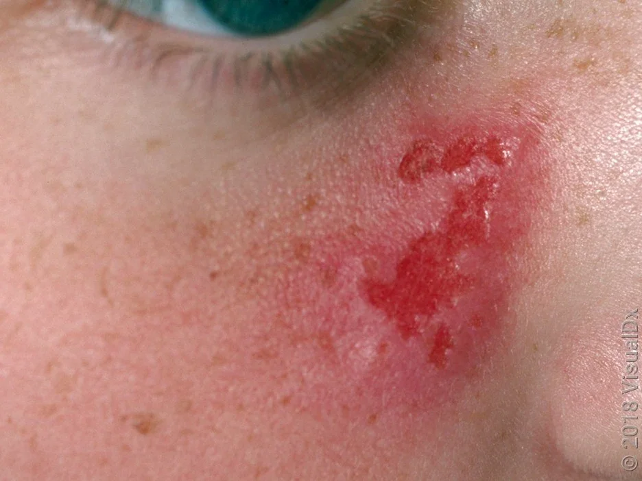 What Does a Cold Sore Look Like? Here’s How to Diagnose One - GoodRx