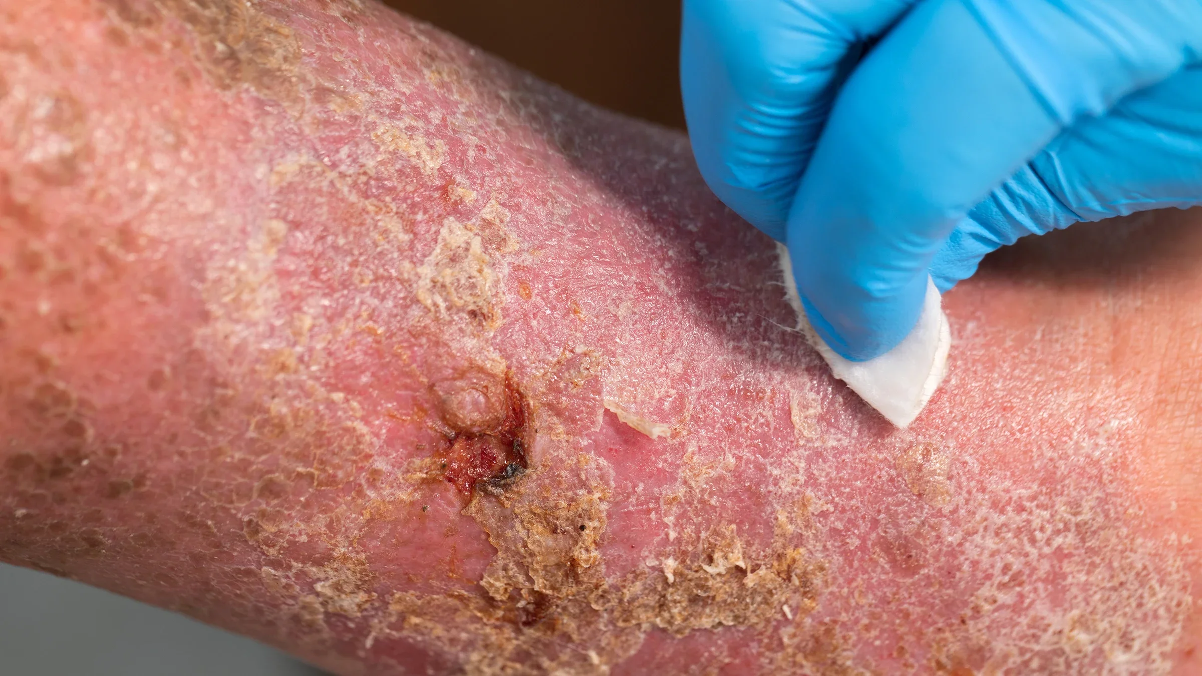 The 6 Stages of Diabetic Foot Ulcers - GoodRx