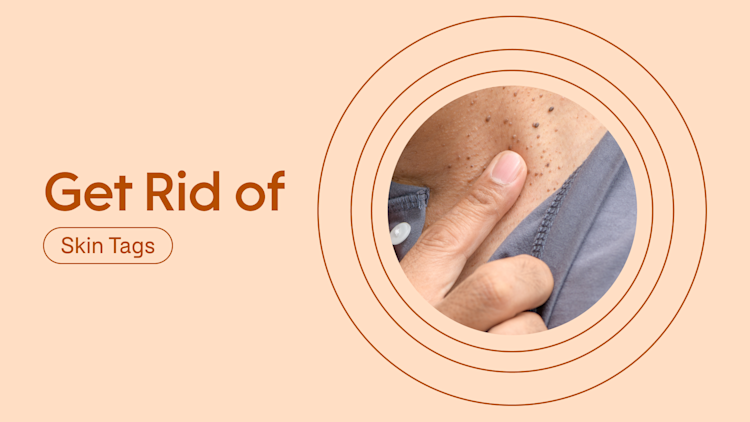 How To Get Rid of Skin Tags? 3 People Share How They Did It - GoodRx