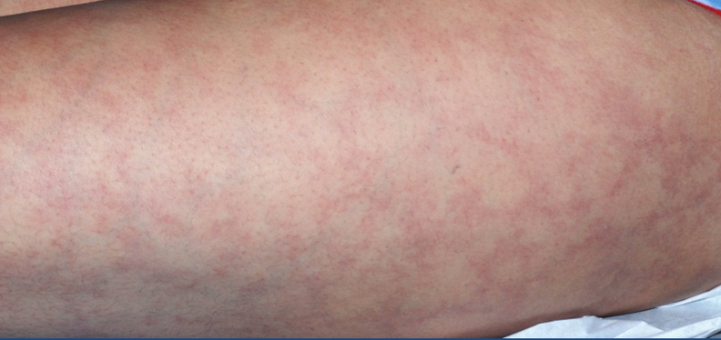 Lupus Rash What It Is And How To Treat It Goodrx