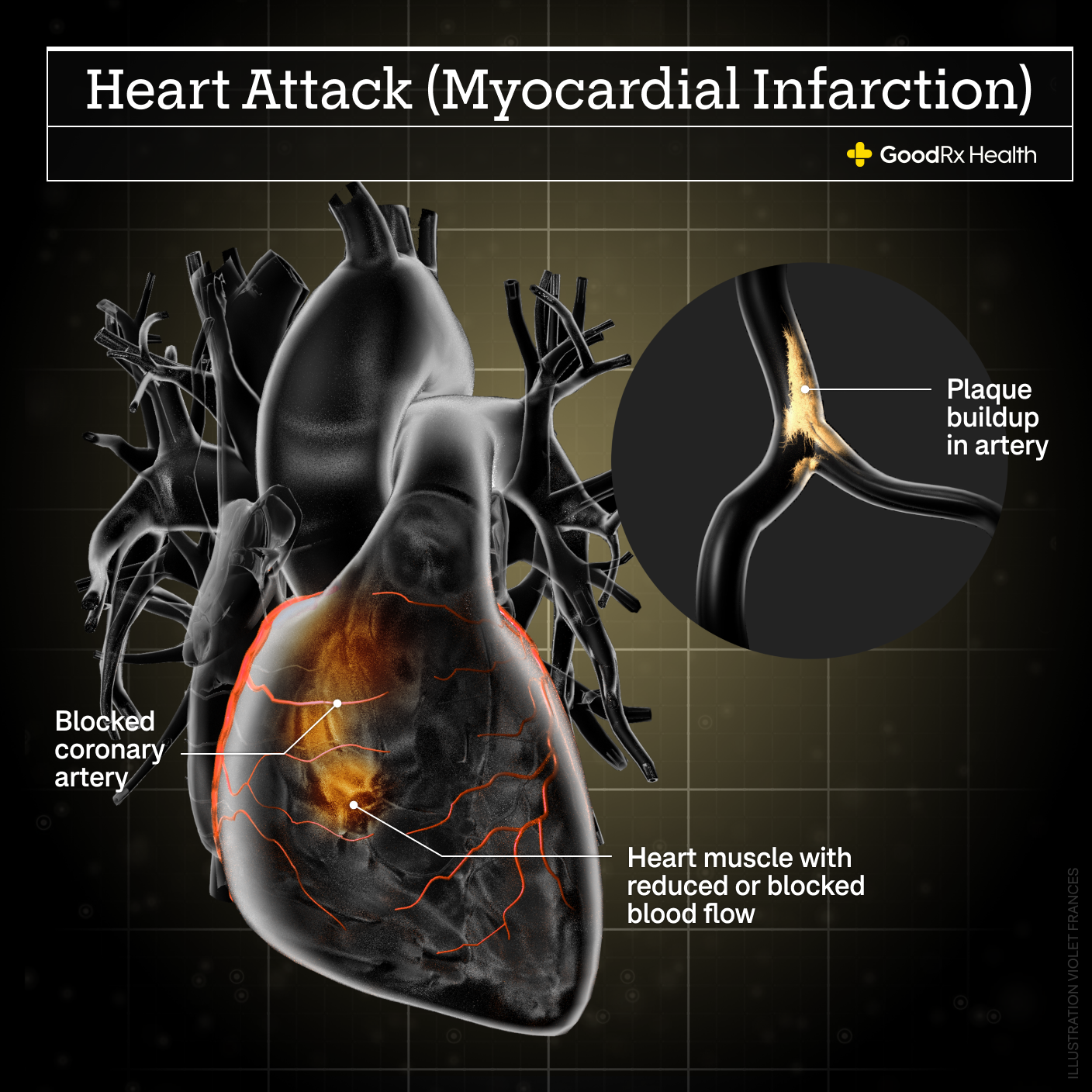 What Is a Heart Attack? Symptoms, Causes,Treatments And More - GoodRx