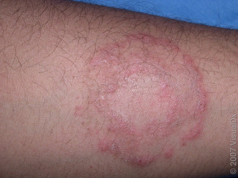 Ringworm: Symptoms, Pictures, Causes, Treatment, & More - GoodRx
