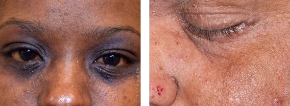 Is It Eczema on My Face? Facial Eczema Images - GoodRx