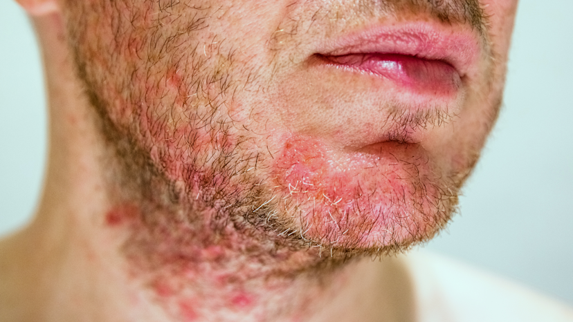 Facial Eczema: Images, Causes, and Treatments - GoodRx