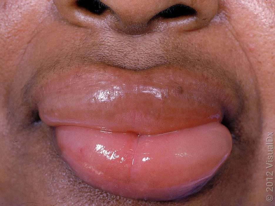 Hives Getting Worse Instead of Better: Causes and Treatment - GoodRx