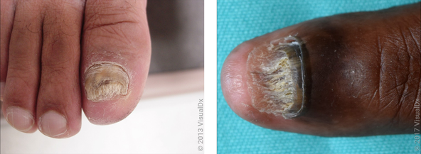 Psoriasis Nails vs. Fungus: Pictures and Differences to Look For - GoodRx