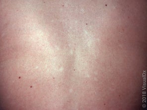 What Does Vitiligo Look Like on White Skin? Images - GoodRx