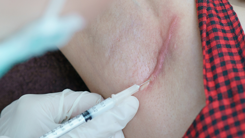 How Can You Get Rid of Keloids? Treatment and Pictures - GoodRx