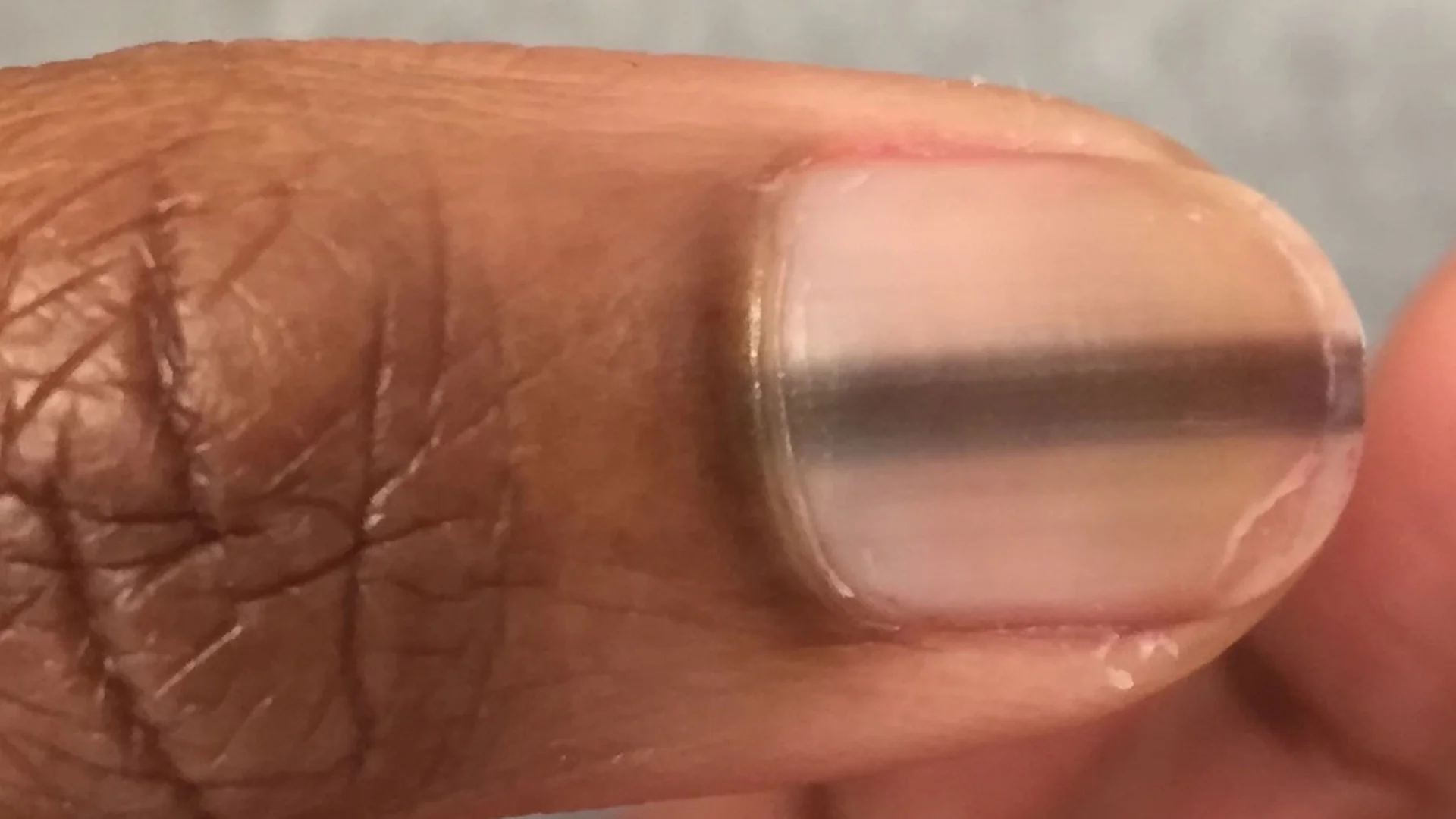Skin Cancer in Black People and Brown Skin Tones (With Images) - GoodRx