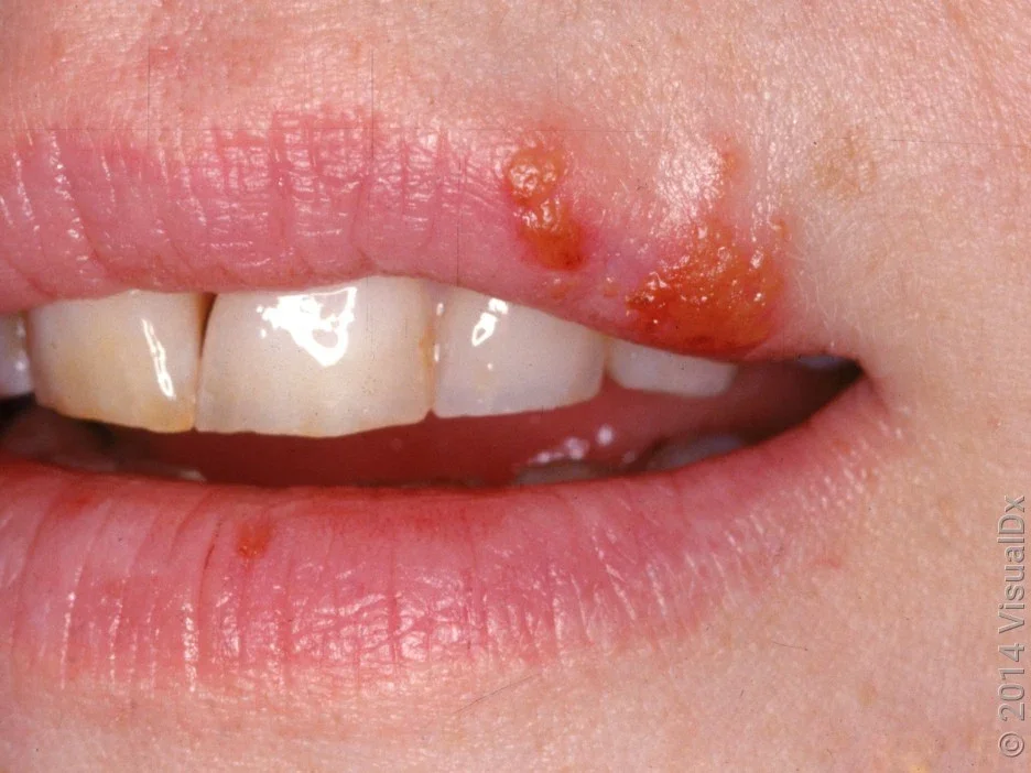 What Does a Cold Sore Look Like? Here’s How to Diagnose One - GoodRx