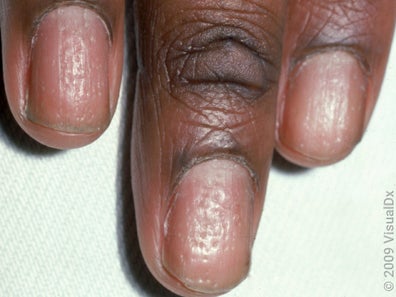 8 Ways Psoriatic Arthritis Affects the Nails - GoodRx